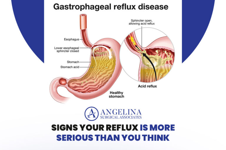 Signs Your Reflux is More Serious Than You Think | Angelina Surgical ...